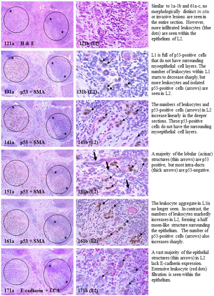 Malignant Transformation and Stromal Invasion from Normal or ...