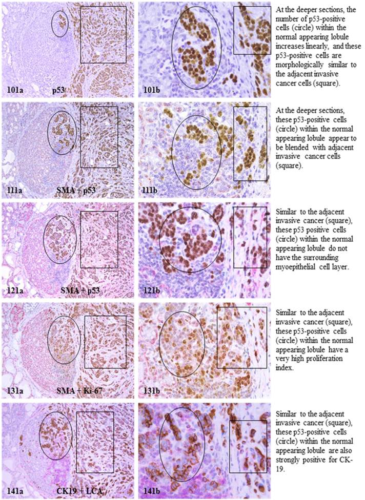 Malignant Transformation and Stromal Invasion from Normal or ...