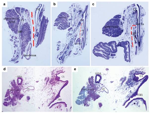 Total mesopancreas excision for the treatment of pancreatic head cancer