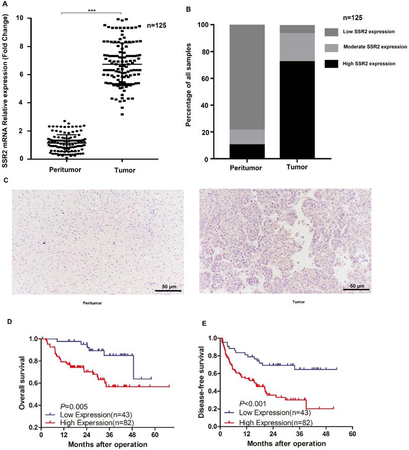 SSR2 overexpression associates with tumorigenesis and metastasis of ...