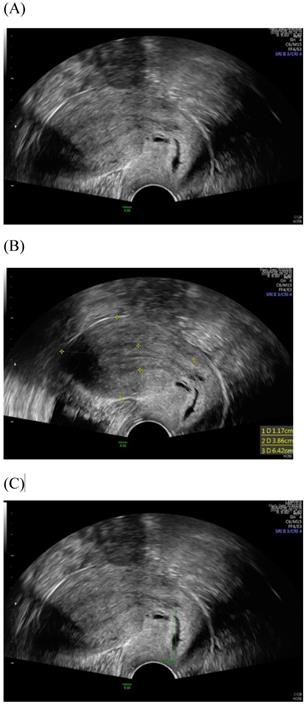 Updated applications of Ultrasound in Uterine Cervical Cancer