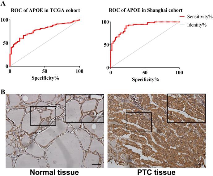 APOE Is a Prognostic Biomarker and Correlates with Immune Infiltrates ...