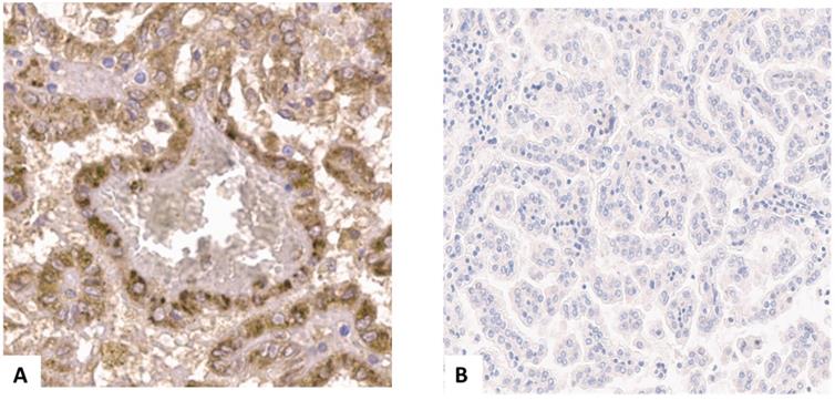 Expression of Prostate-specific Membrane Antigen (PSMA) in Papillary ...