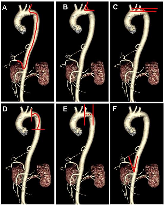 A Novel Thoracoabdominal Aorta CTA-based Nomogram Model to Identify ...