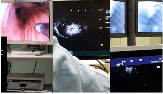 Endobronchial Radiofrequency Ablation for pulmonary nodules with Radial ...