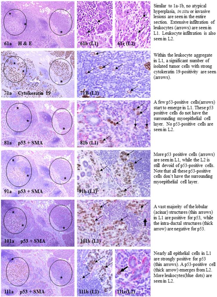 Malignant Transformation and Stromal Invasion from Normal or ...