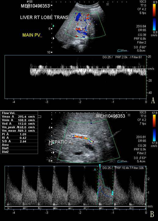 Dactinomycin-induced Hepatic Sinusoidal Obstruction Syndrome Responding ...