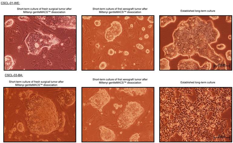 Colon Cancer Cells Under Microscope