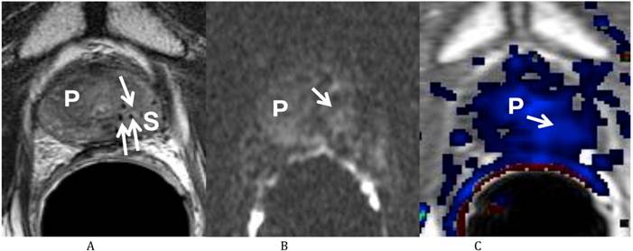 Multi-Parametric MRI-Directed Focal Salvage Permanent Interstitial ...