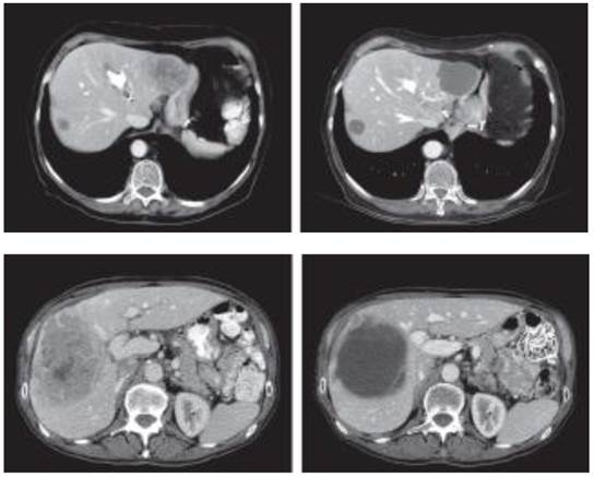 Future Directions for Monitoring Treatment Response in Colorectal Cancer
