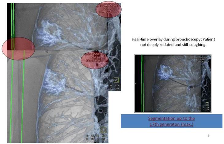 Cone Beam Computertomography (CBCT) in Interventional Chest Medicine ...