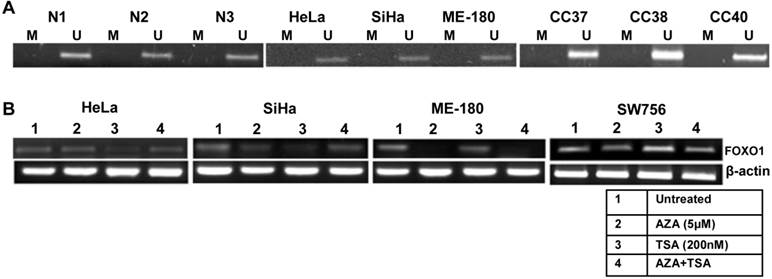 Down Regulation of FOXO1 Promotes Cell Proliferation in Cervical Cancer