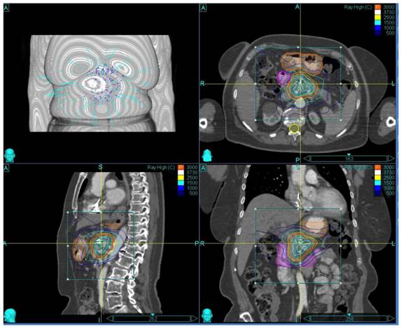 Stereotactic Body Radiotherapy (SBRT) Reirradiation for Recurrent ...
