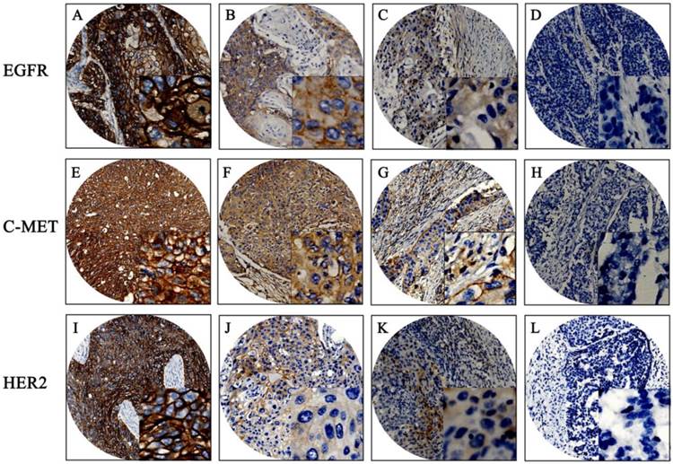 C-Met as a Molecular Marker for Esophageal Squamous Cell Carcinoma and ...