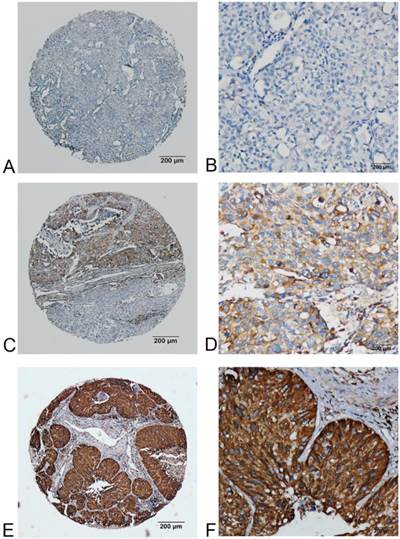 Reduced Expression of FADS1 Predicts Worse Prognosis in Non-Small-Cell ...