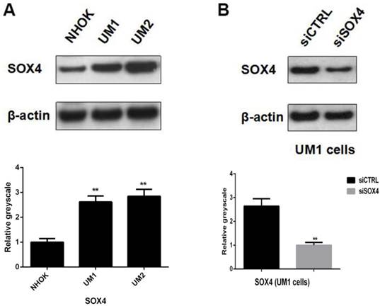 SOX4 Promotes Progression in OLP-Associated Squamous Cell Carcinoma
