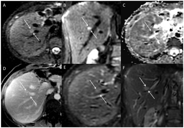 Hepatocellular Carcinoma and Diffusion-Weighted MRI: Detection and ...
