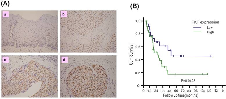 Transketolase Serves a Poor Prognosticator in Esophageal Cancer by ...