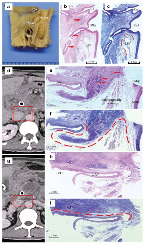 Total mesopancreas excision for the treatment of pancreatic head cancer