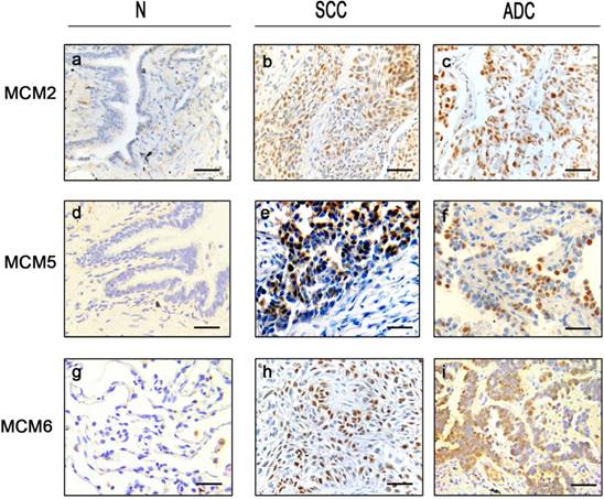 MCMs expression in lung cancer: implication of prognostic significance