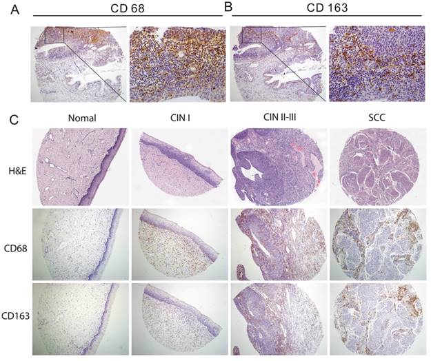 Clinical Significance of CD163+ and CD68+ Tumor-associated Macrophages ...
