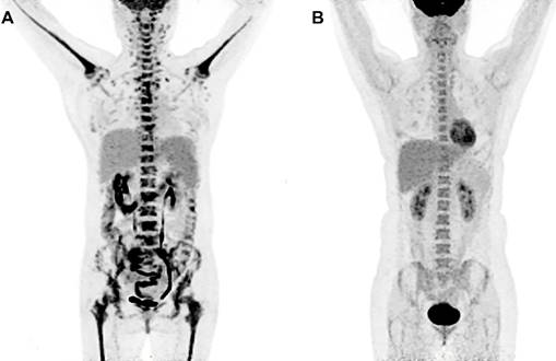 A predicting model of bone marrow malignant infiltration in 18F-FDG PET ...
