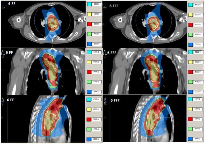 Comparison of treatment plan quality of VMAT for esophageal carcinoma ...