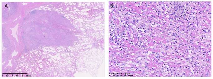 Epithelioid Trophoblastic Tumors: Treatments, Outcomes, and Potential ...