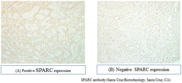 The impact of SPARC expression on the survival of pancreatic ductal ...