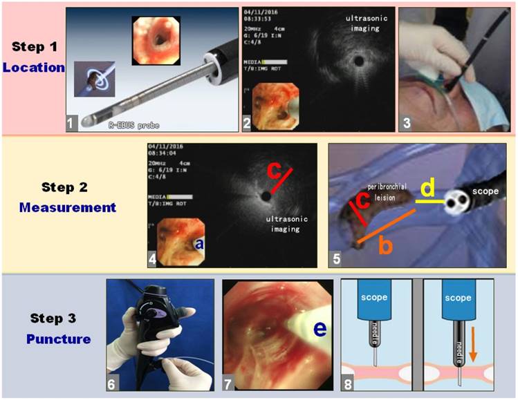 Radial probe endobronchial ultrasound assisted conventional ...