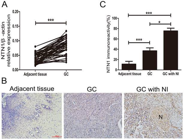 Netrin-1 promotes cell neural invasion in gastric cancer via its ...