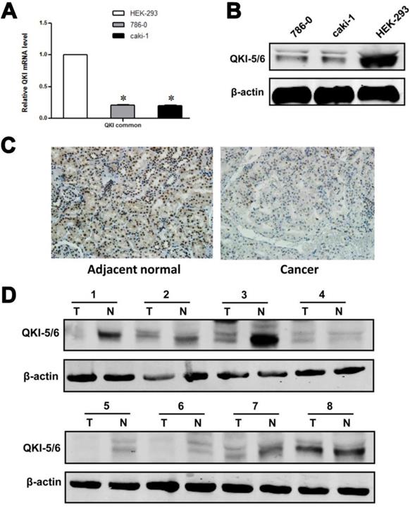 The RNA-binding protein QKI suppresses tumorigenesis of clear cell ...