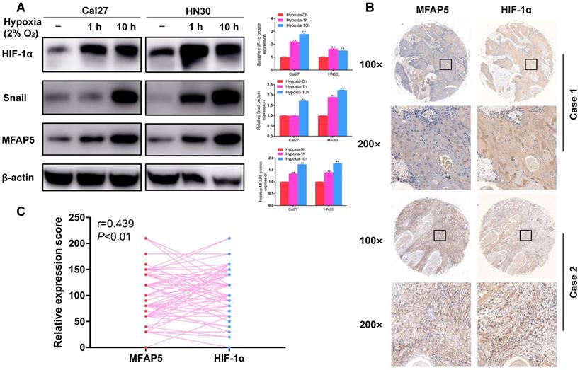 Hypoxia-induced MFAP5 Promotes Tumor Migration and Invasion via AKT ...