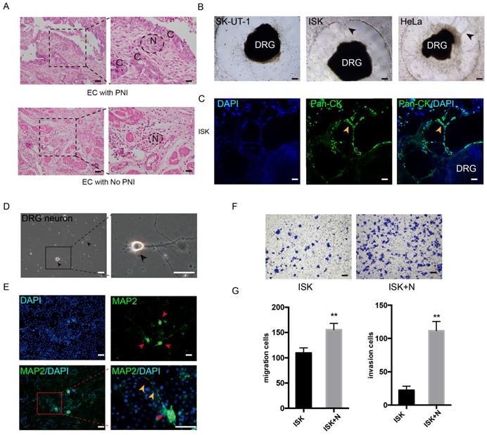 DRG Neurons Promote Perineural Invasion of Endometrial Cancer via GluR2