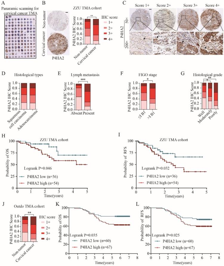 P4HA2 contributes to cervical cancer progression via inducing ...