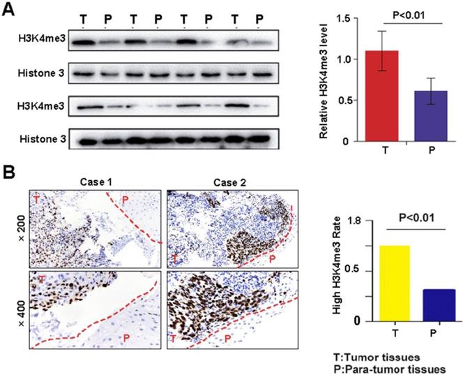 High level of H3K4 tri-methylation modification predicts poor prognosis ...
