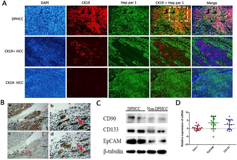 Overexpression of Epcam and CD133 Correlates with Poor Prognosis in ...