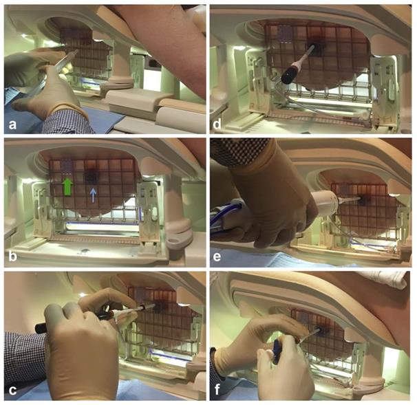 Recent Progress for the Techniques of MRI-Guided Breast Interventions ...