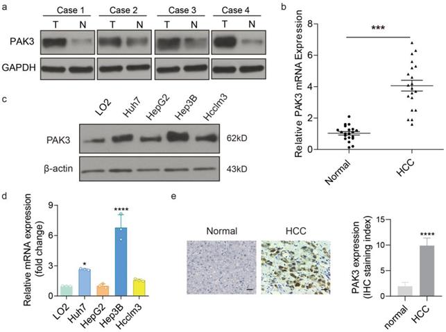 PAK3 promotes the metastasis of hepatocellular carcinoma by regulating ...