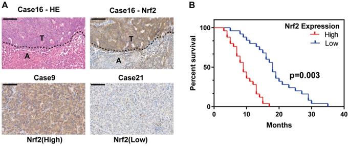 Combination of Metformin and Sorafenib Induces Ferroptosis of ...