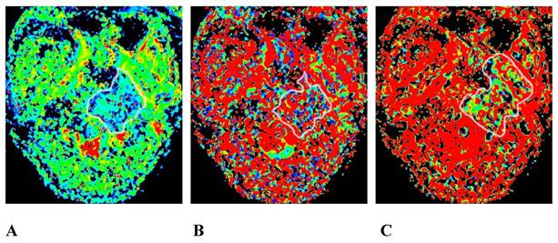 Feasibility evaluation of intravoxel incoherent motion diffusion ...