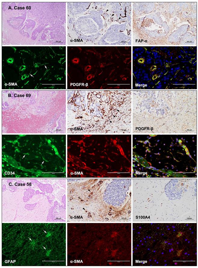 Different Expression and Clinical Implications of Cancer-Associated ...