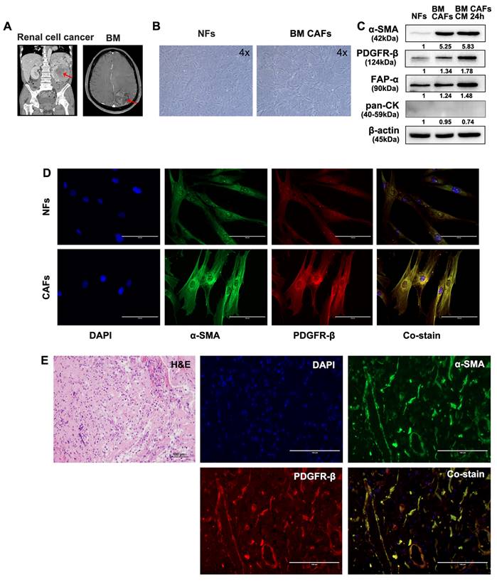 Different Expression and Clinical Implications of Cancer-Associated ...