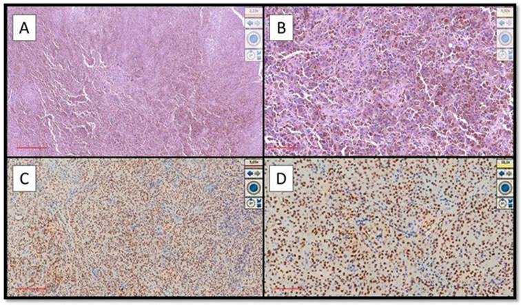 PReferentially Expressed Antigen in MElanoma (PRAME): preliminary ...