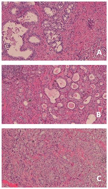 Palliative TURP Combined with Intermittent ADT Is A Curative Therapy to ...