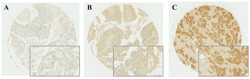 Protein expression of S100A2 reveals it association with patient ...