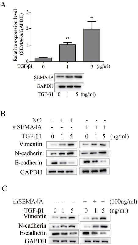 SEMA4A promotes prostate cancer invasion: involvement of tumor ...
