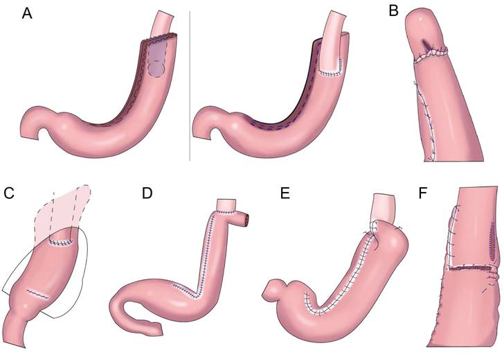Digestive tract reconstruction after laparoscopic proximal gastrectomy ...