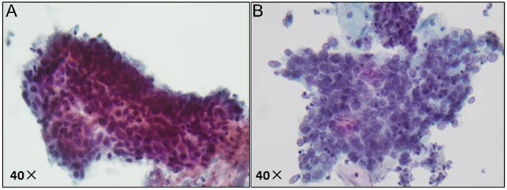 Prevalence of cervical precancers or cancers in women with ASC-H/HSIL ...