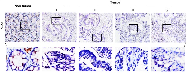 Decreased Expression of PLD2 Promotes EMT in Colorectal Cancer Invasion ...